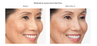 Reduce and Smooth Forehead & Squint Lines - Best Plastic Surgeons San Diego